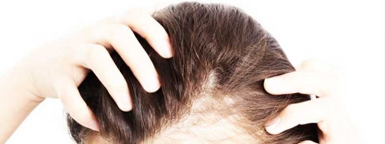 Female Pattern Baldness (Symptoms, Causes, Natural Remedy & Hairstyle)